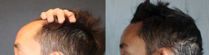 Hairline Lowering Beverly Hills | Forehead Reduction Los Angeles